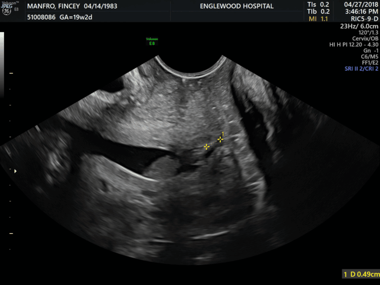 "At Your Cervix": Screening & Treatment of a Shortened Cervix during ...