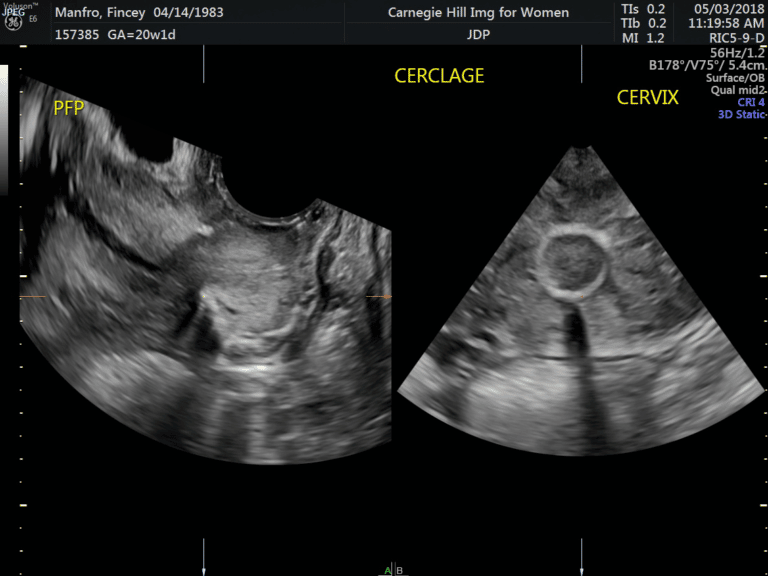 "At Your Cervix": Screening & Treatment of a Shortened Cervix during ...